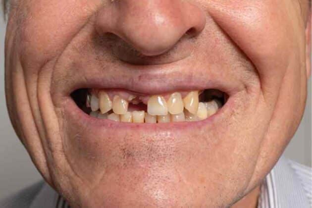Possible Solutions for a Chipped Front Tooth