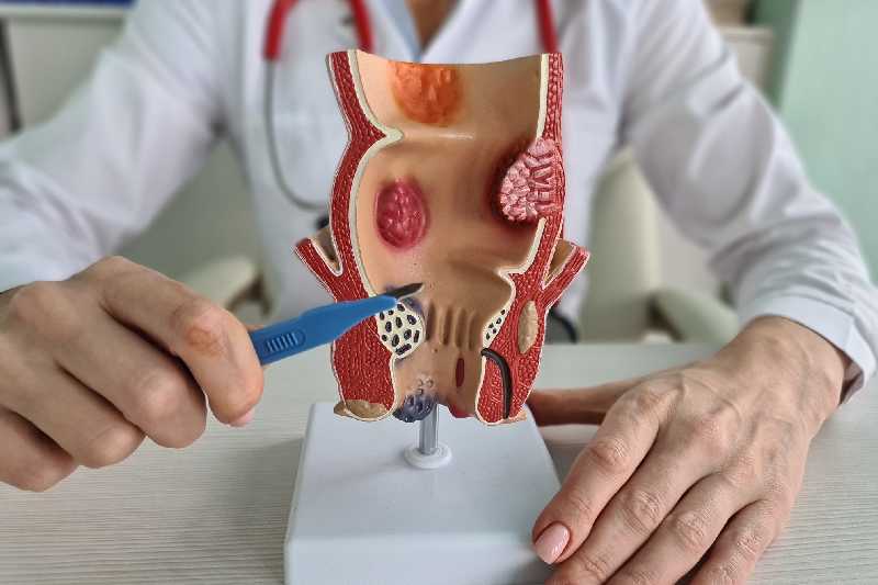 What causes haemorrhoids and how can they be removed?