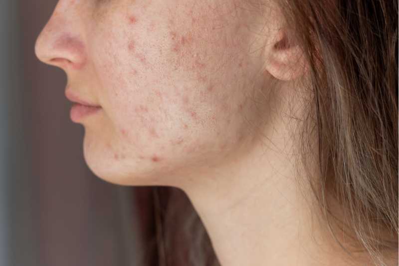 Pigmentation Removal Singapore: What does a bad Pigmentation look Like?